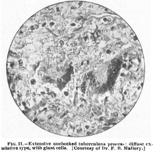 Massachusetts Medical Society: Surgical Tuberculosis