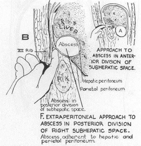 Massachusetts Medical Society: The Subphrenic Spaces and the Emperor's ...